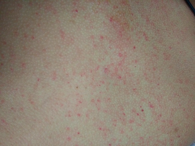 Trombositopenia - patofisiologi, diagnosis, penatalaksanaan - Alomedika