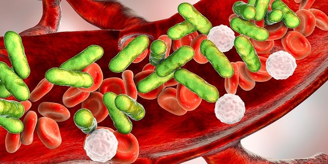 Pedoman Sepsis dan Syok Sepsis pada Anak Terbaru - Alomedika