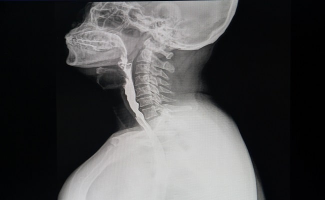Disfagia - patofisiologi, diagnosis, penatalaksanaan - Alomedika