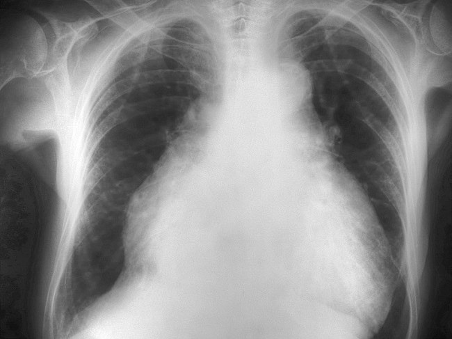 Diagnosis Gagal Jantung - Alomedika