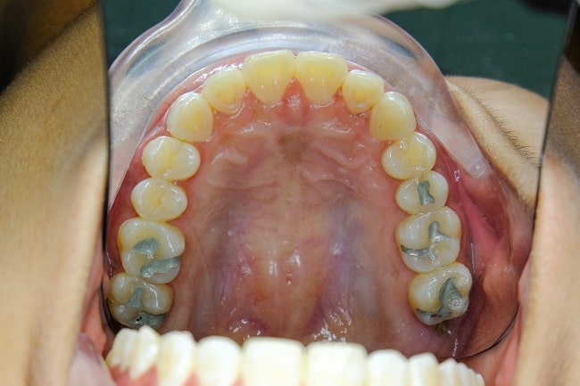 Toksisitas Restorasi Dental Amalgam - Alomedika