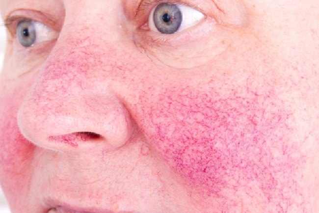 Pemilihan Bentuk Sediaan Antibiotik untuk Penanganan Rosacea - Alomedika