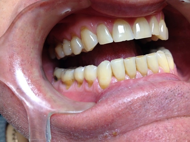 Penatalaksanaan Abrasi dan Erosi Gigi - Alomedika