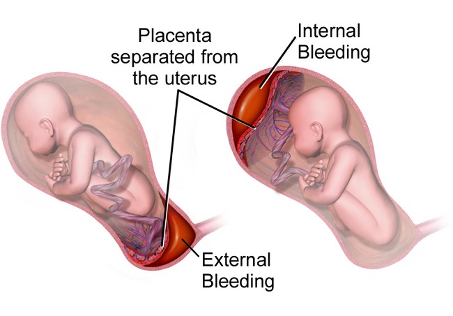Abrupsio Plasenta - patofisiologi, diagnosis, penatalaksanaan - Alomedika