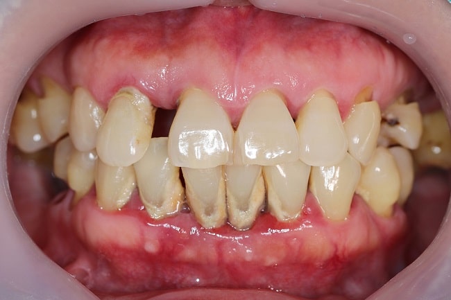 Diagnosis Periodontitis - Alomedika