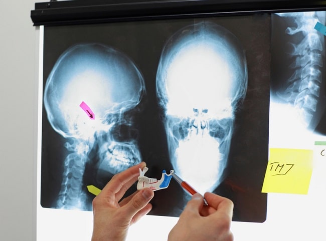Diagnosis Dislokasi Temporomandibular Joint (TMJ) - Alomedika
