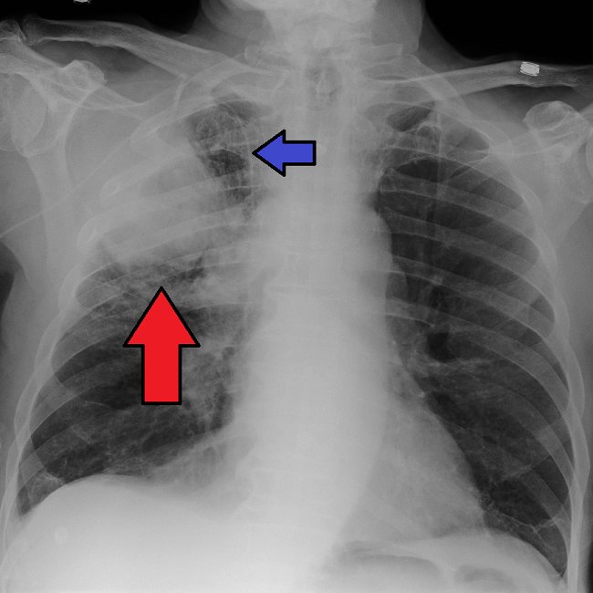 Kanker Paru - patofisiologi, diagnosis, penatalaksanaan - Alomedika