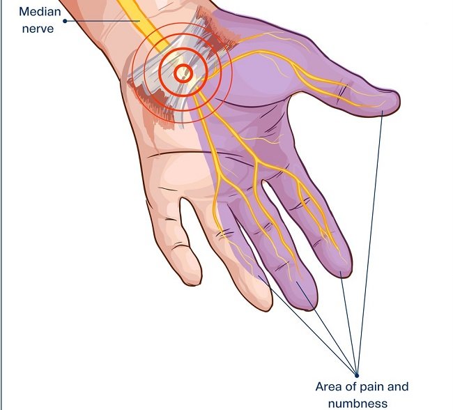 Injeksi Kortikosteroid dengan Panduan USG untuk Terapi Carpal Tunnel ...