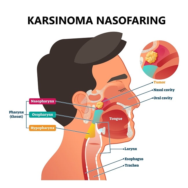 Karsinoma Nasofaring - patofisiologi, diagnosis, penatalaksanaan - Alomedika