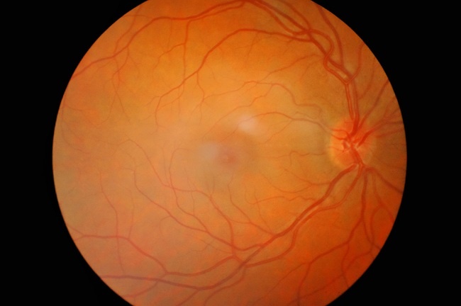 Prognosis Retinopati - Alomedika