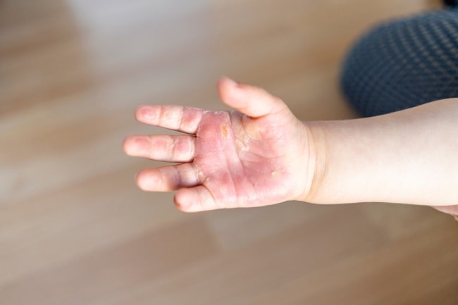 Diagnosis Luka Bakar Pada Anak - Alomedika