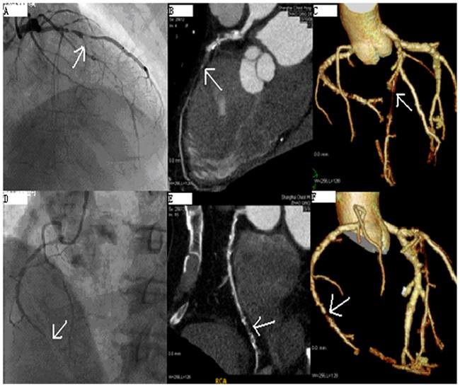 Pemeriksaan Coronary Computed Tomography Angiography untuk Nyeri Dada - Alomedika