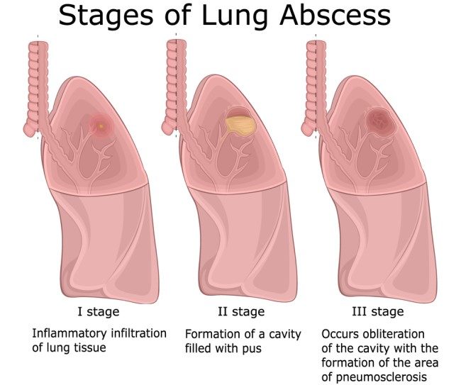 Diagnosis Abses Paru - Alomedika