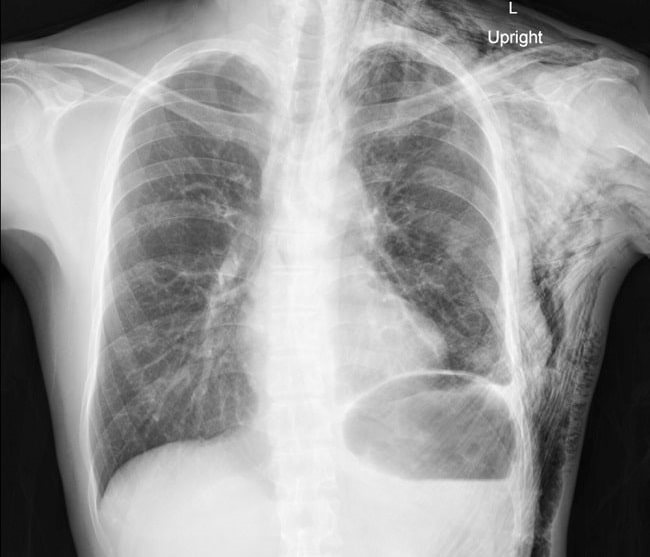 Diagnosis Emfisema Subkutis - Alomedika