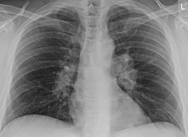 Sarkoidosis - patofisiologi, diagnosis, penatalaksanaan - Alomedika
