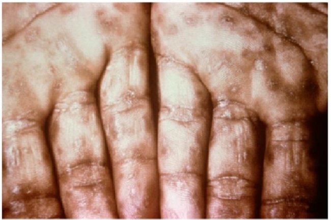 Epidemiologi Sifilis - Alomedika