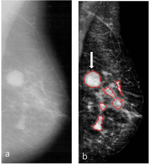 Diagnosis Kanker Payudara - Alomedika