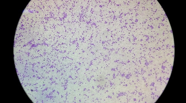 Trombositosis - patofisiologi, diagnosis, penatalaksanaan - Alomedika