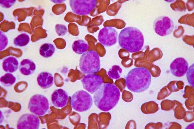 Diagnosis Leukemia - Alomedika