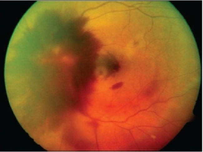Etiologi Perdarahan Vitreus - Alomedika