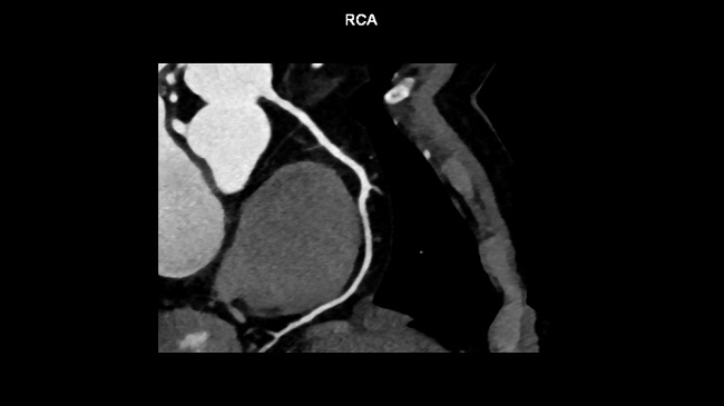 Penggunaan Coronary CT Angiography pada Angina Pektoris Stabil - Alomedika