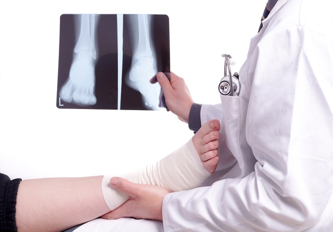 Peran Ottawa Ankle Rules dalam Mendiagnosis Ankle Fracture - Alomedika