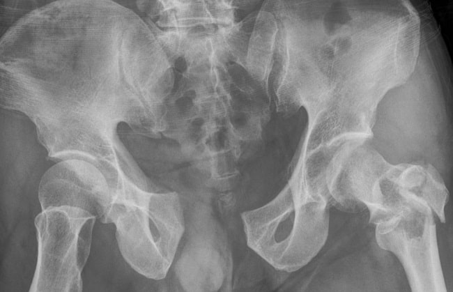 Diagnosis Fraktur Pelvis - Alomedika