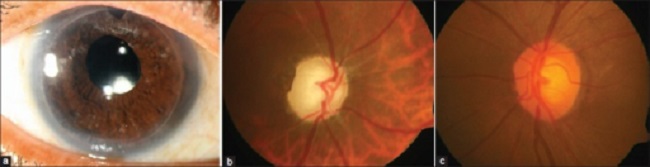 Glaukoma Sekunder Pascaoperasi Katarak Kongenital - Alomedika