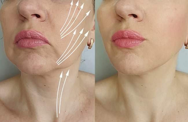 Manfaat dan Profil Risiko Stem Cell Facelift - Alomedika