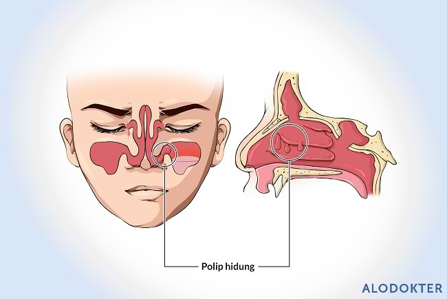 Pencegahan Polip Hidung - Alodokter