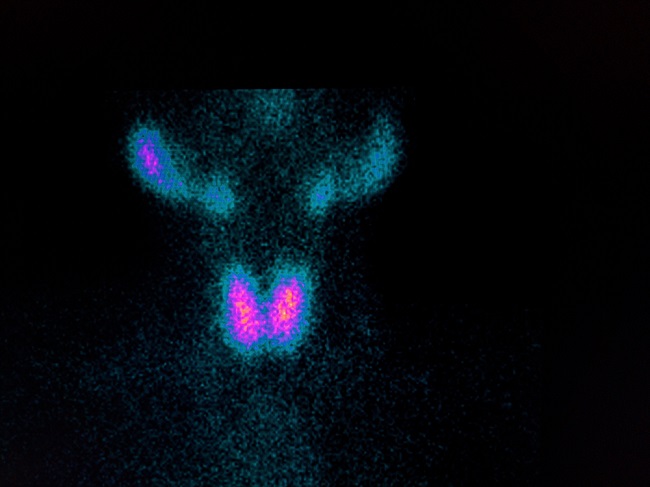 Peran Thyroid Scintigraphy dalam Mendiagnosis Kelainan Tiroid - Alomedika