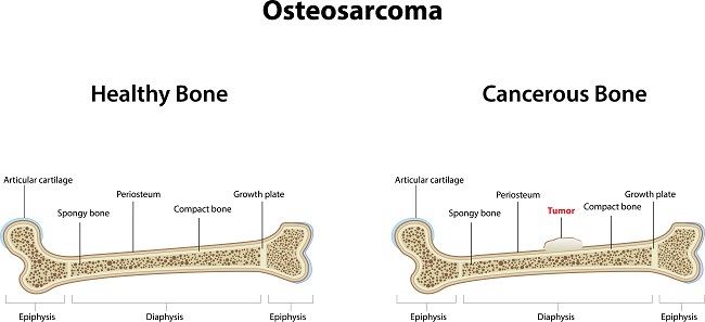 Osteosarkoma - patofisiologi, diagnosis, penatalaksanaan - Alomedika