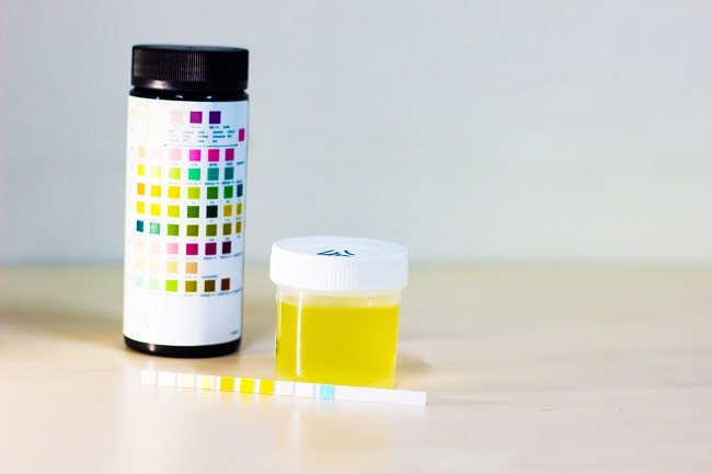 Diagnosis Glukosuria - Alomedika