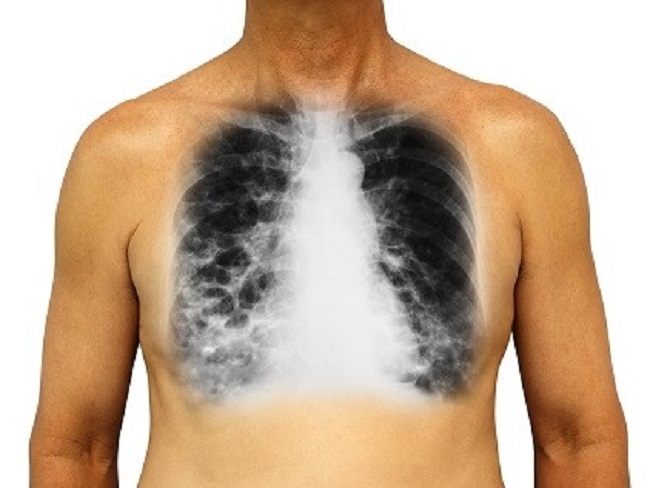 Bronkiektasis - Gejala, Penyebab, dan Pengobatan - Alodokter