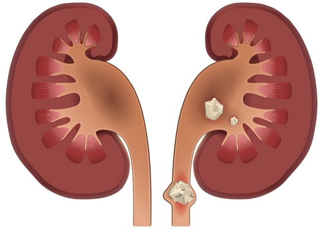 Batu Saluran Kemih Bahasa Medis - Perumperindo.co.id