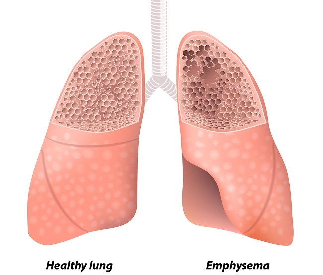 Diagnosis Emfisema - Alomedika