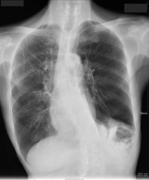 Diagnosis Penyakit Paru Obstruktif Kronik - Alomedika