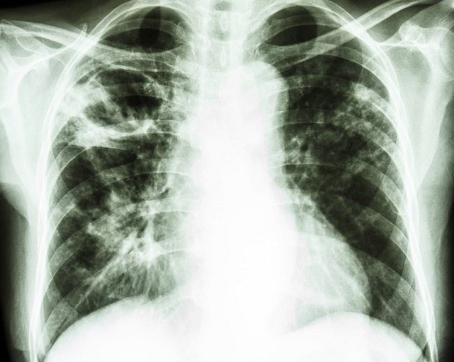 Diagnosis TB MDR - Alomedika