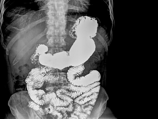 Manfaat USG dalam Mendiagnosis Obstruksi Usus Halus - Alomedika