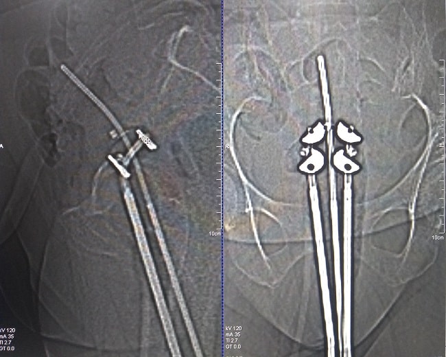 Brakhiterapi - teknik, indikasi, komplikasi, pedoman klinis - Alomedika