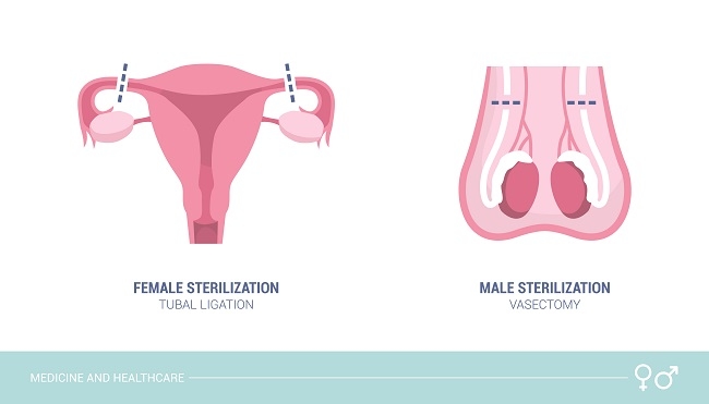 Operasi Steril, Ini yang Harus Anda Ketahui - Alodokter