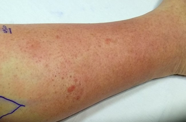 Terapi Selulitis - Perumperindo.co.id