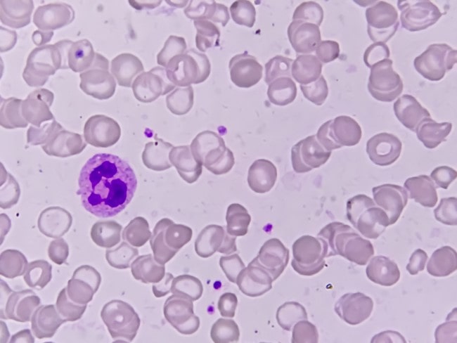 Diagnosis Anemia Hemolitik - Alomedika