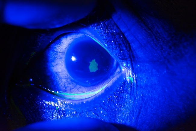 Efektivitas dan Keamanan Penggunaan Anestetik Topikal pada Abrasi ...