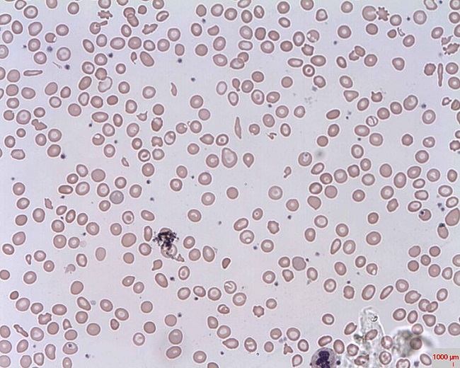 Diagnosis Thalassemia - Alomedika