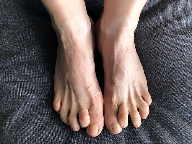 Penatalaksanaan Hammertoe dan Claw Toe - Alomedika