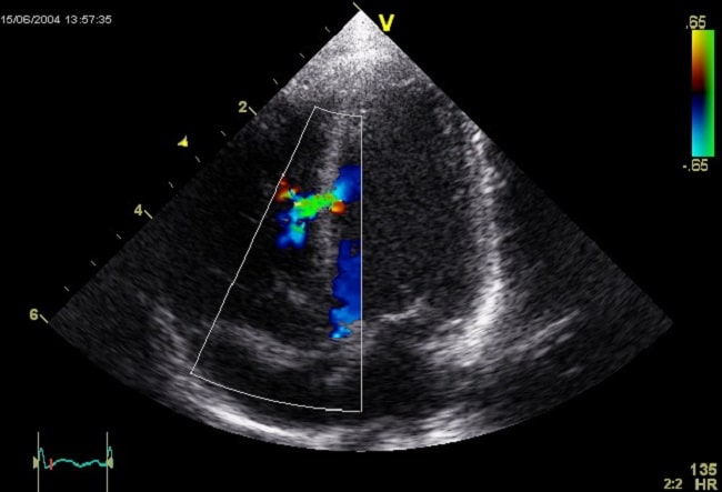 Diagnosis Ventricular Septal Defect - Alomedika