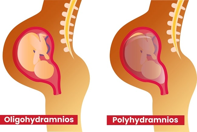 Polyhidramnion - patofisiologi, diagnosis, penatalaksanaan - Alomedika
