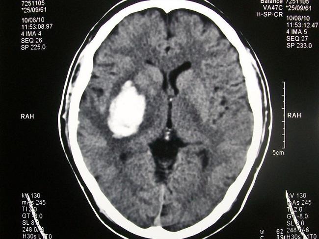 Target Tekanan Darah pada Pasien dengan Pendarahan Intraserebral Akut ...