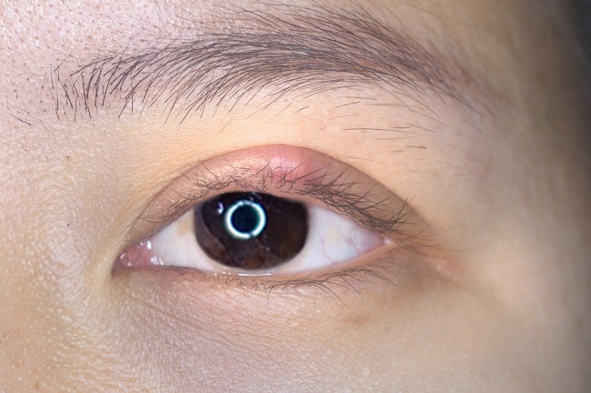 Diagnosis Kalazion - Alomedika